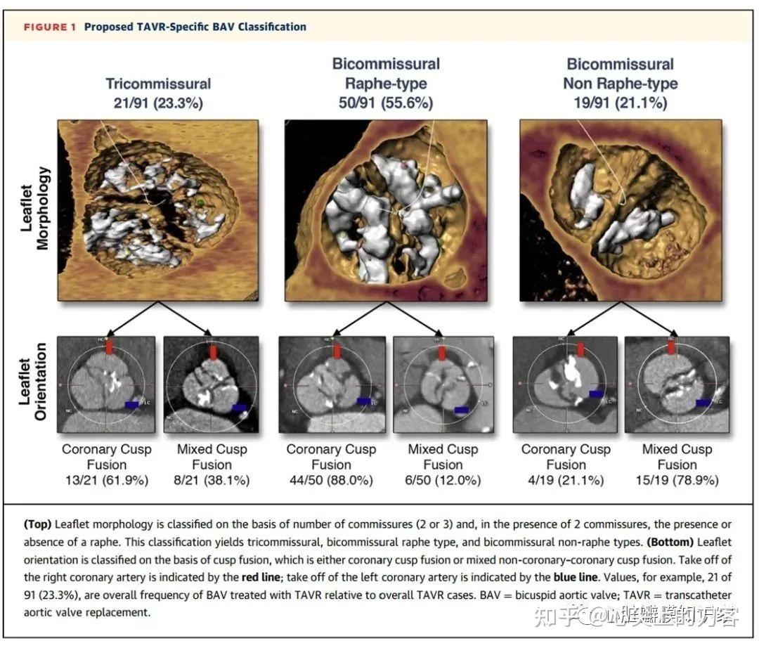 二叶式主动脉瓣畸形之一 分型 - 知乎