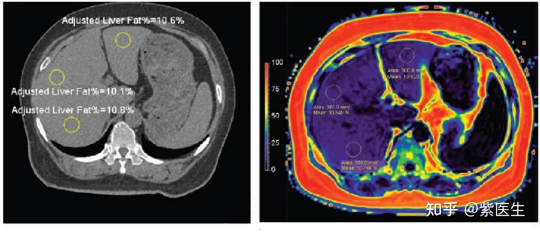 定量CT（QCT）是什么？临床应用有哪些？ - 知乎