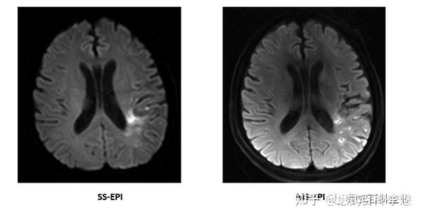 IRIS：多激发SE-EPI扩散（弥散）序列 - 知乎