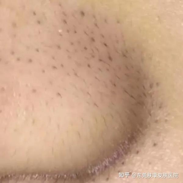去黑头的有效方法！！【东莞肤康】 知乎