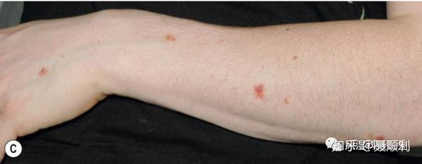 易跟过敏性紫癜混淆的疾病有哪些？（完结篇） - 知乎