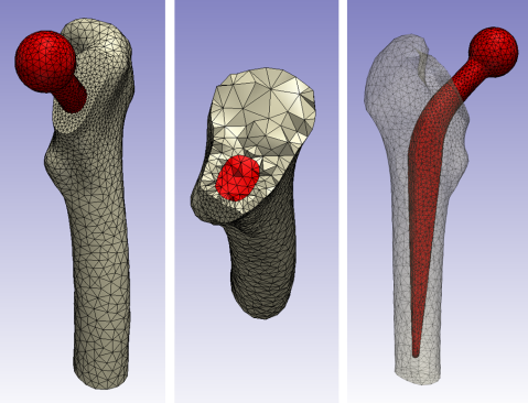 【Simpleware】教程：导入和放置 CAD 植入物：股骨近端 - 知乎