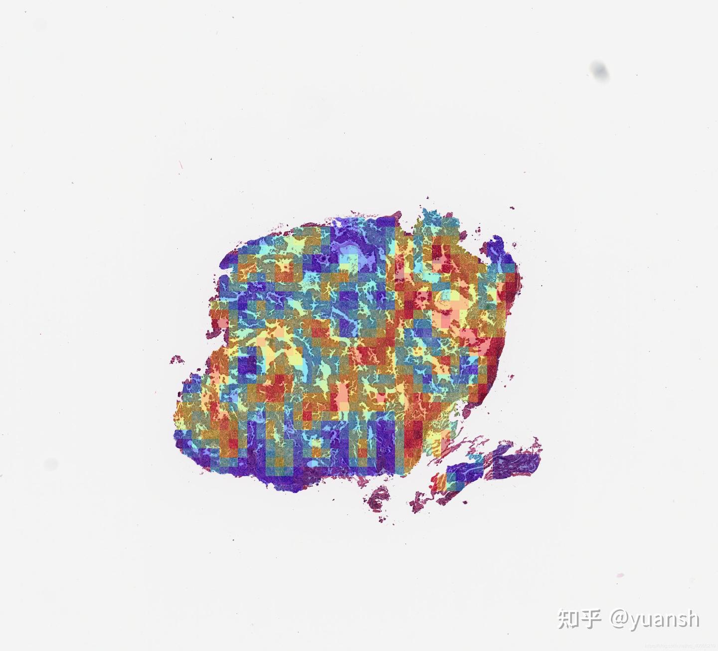 CLAM: A Deep-Learning-based Pipeline for Data Efficient and Weakly Supervised Whole-Slide-level ...