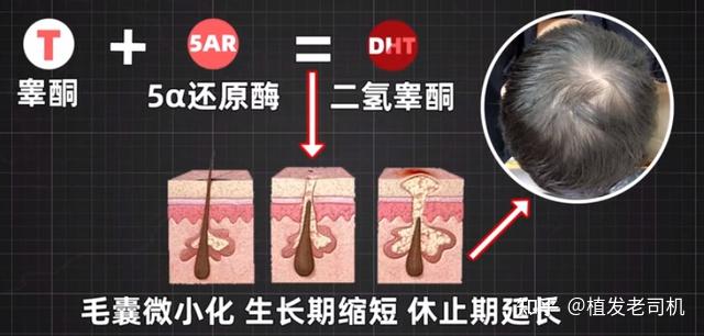 如何抑制或减少DHT生成? - 知乎