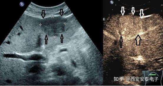 ATA-4315高压功率放大器——超声医疗领域应用 - 知乎