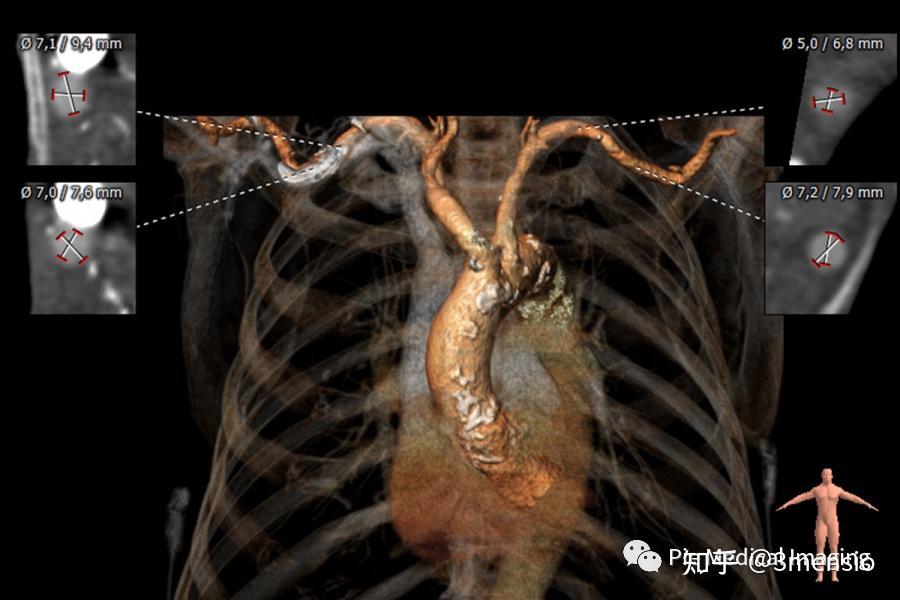 3mensio Aortic - 知乎