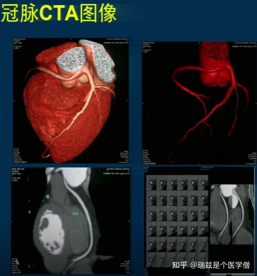 手把手教你读懂冠脉CTA - 知乎