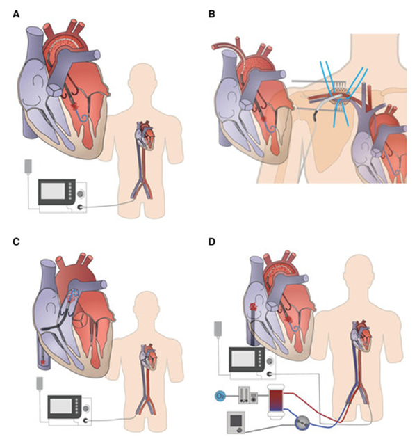 介入式心室辅助装置Impella的结构、特点、并发症及防治 - 知乎