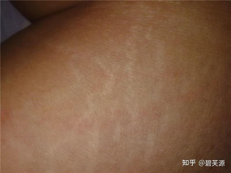 用什么办法能祛除大腿上的橘皮纹 知乎