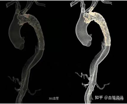 WeFlow-Tbranch单内嵌分支胸主动脉覆膜支架系统临床试验随访结果 - 知乎