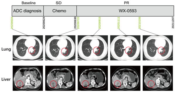 文章发表 | 案例报道：NGS检测指导罕见Intergenic-ALK基因融合肺腺癌患者临床精准治疗 - 知乎