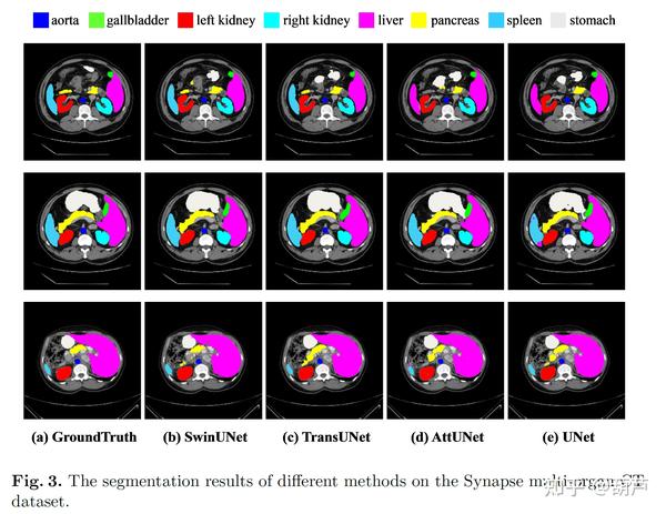 Swin-Unet: Unet-like Pure Transformer for Medical Image Segmentation - 知乎