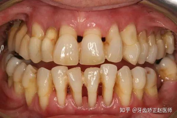 牙龈萎缩了,还可以长回来吗? 知乎