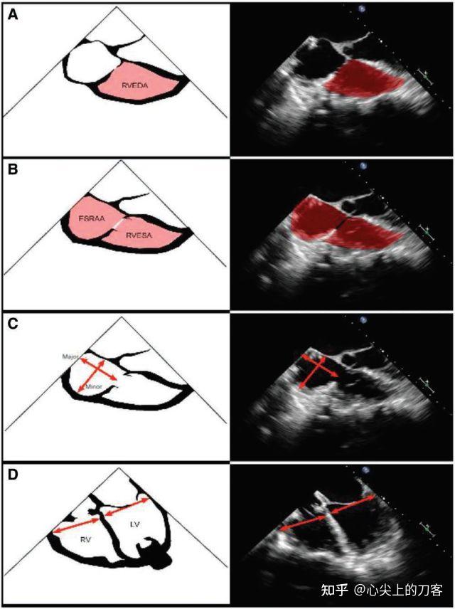 左心室辅助装置植入后右心衰竭相关的术中血流动力学和超声心动过图情况 - 知乎