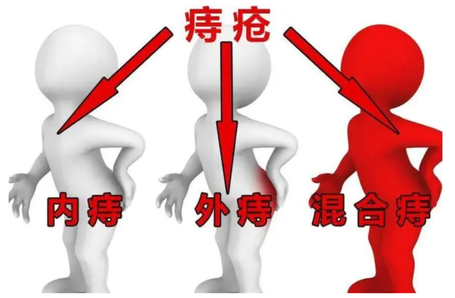 痔疮便血怎么办什么方法最有效? 知乎