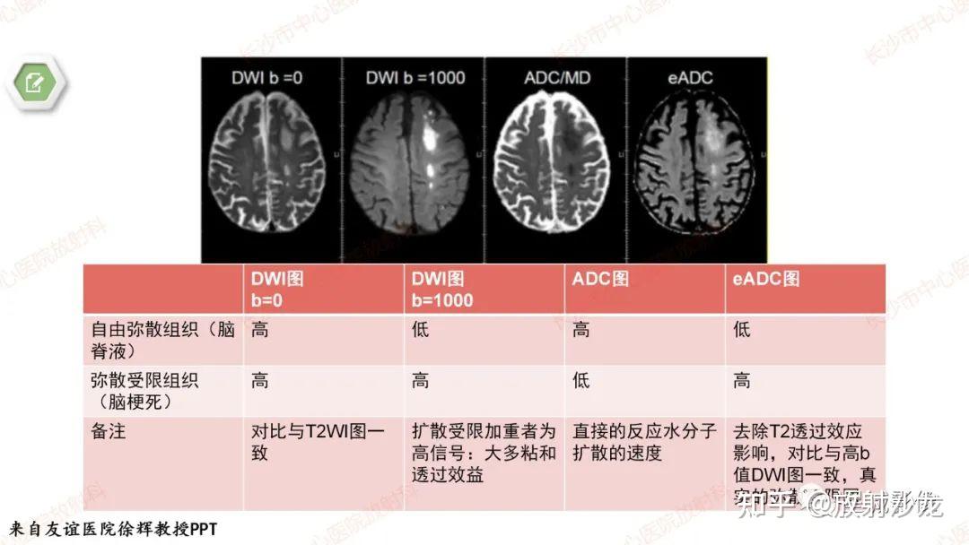 DWI序列判读原则及临床应用 - 知乎