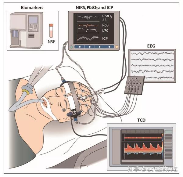 心脏骤停后的神经监测 - 知乎