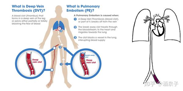 VTE、DVT与PE的关系 - 知乎