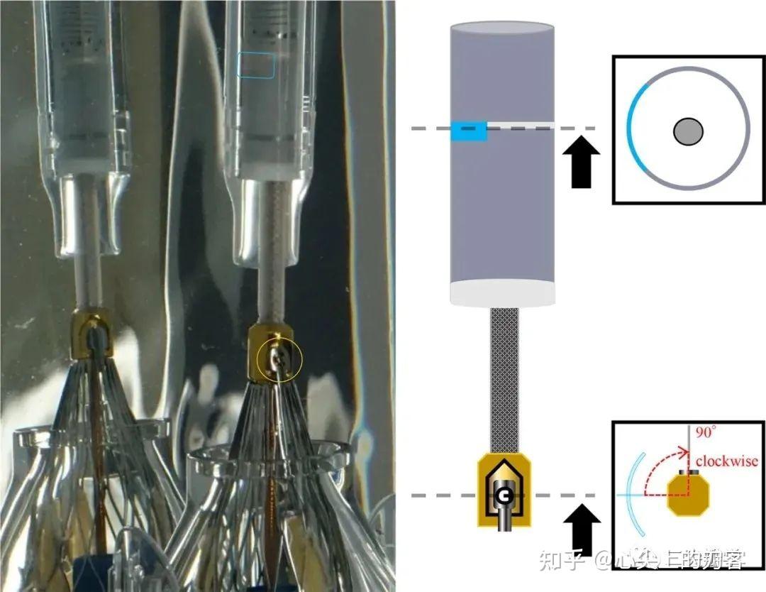 连合对齐（Commissural Alignment）：原理、定义、技术和结果（中） - 知乎