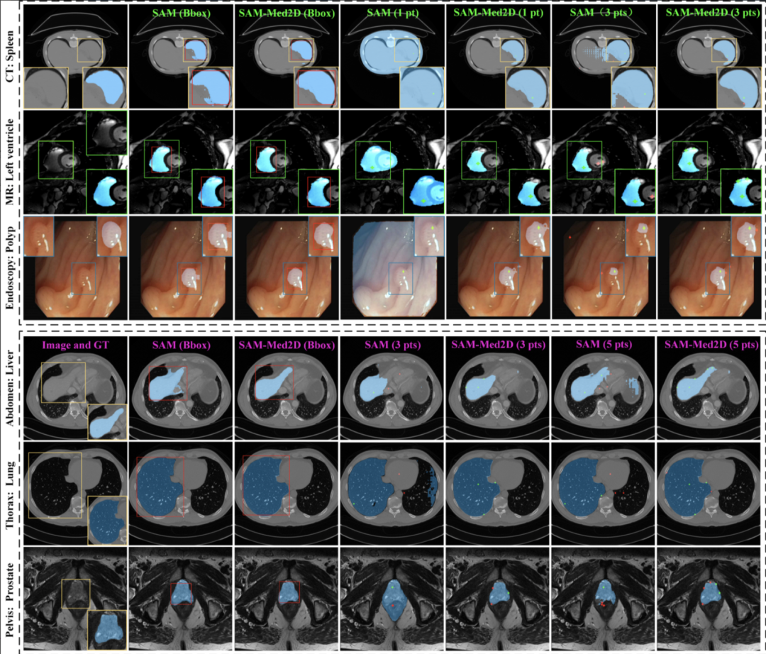 SAM-Med2D：打破自然图像与医学图像的领域鸿沟，医疗版 SAM 开源了！ - 知乎