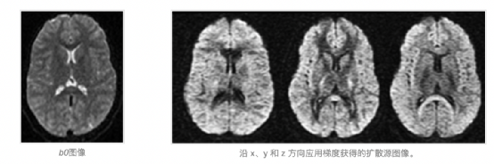 什么是 Trace DWI？它与ADC图有什么不同？ - 知乎