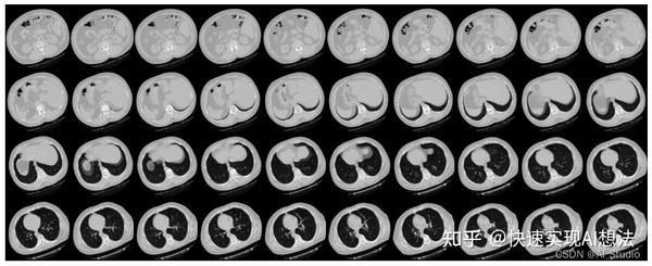 MosMedData: 新冠肺炎胸部 CT扫描数据集上基于3D-CNN实现二分类 - 知乎