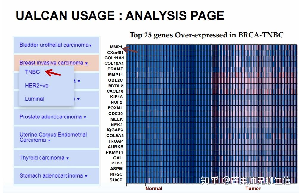 肿瘤免疫 · 实操教程Day10.UALCAN使用教程 - 知乎