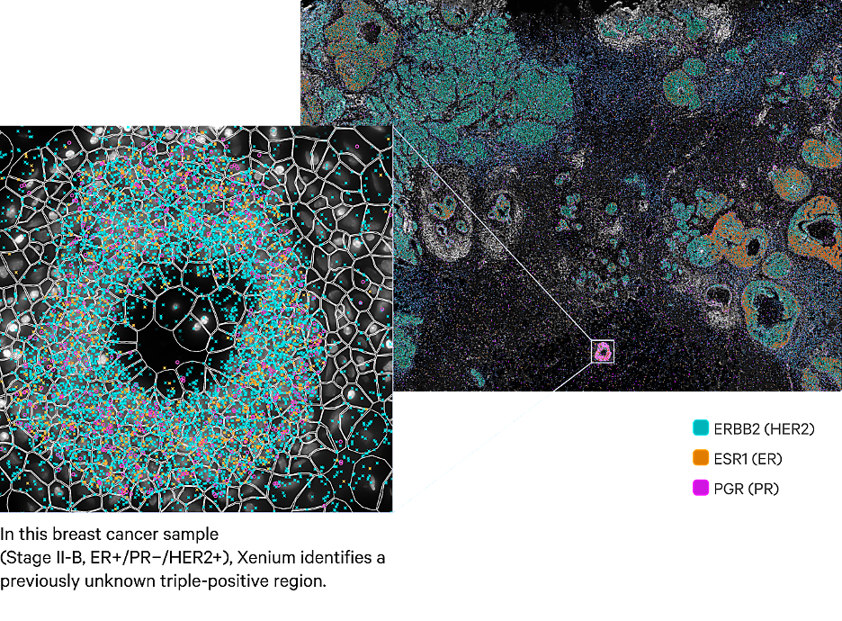 如何让大海捞针更精确？10x Genomics公司Xenium原位分析技术助力发现罕见的癌症生物学特征 - 知乎