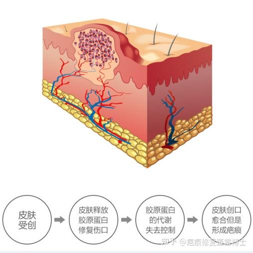 术后瘢痕疙瘩的你们是怎么忌口的? 知乎