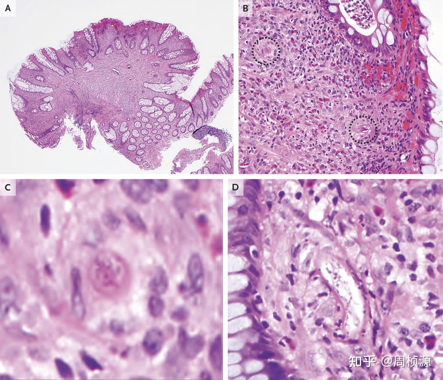 Nejm 2014 Case 28 - 知乎