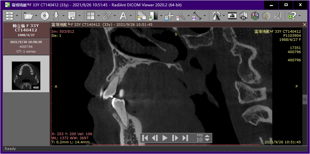 使用NNT Viewer把CBCT进行格式转化（.a111->.dcm） - 知乎