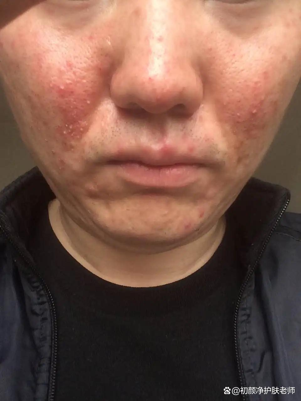 激素脸修复需要多长时间？我用亲身经历来教你 知乎