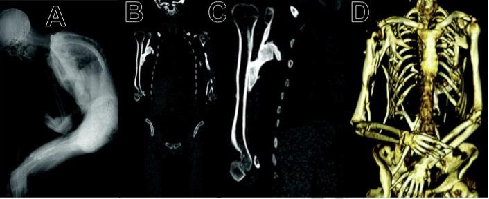 FOP的影像学评估：定性/定量分析与疑难问题 - 知乎