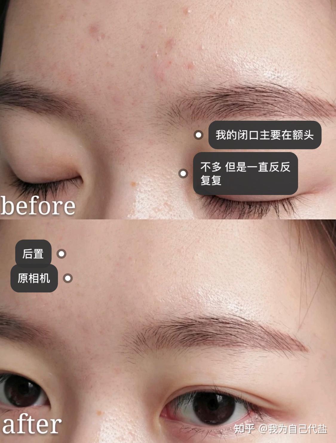 闭口和粉刺怎样去除？ - 知乎