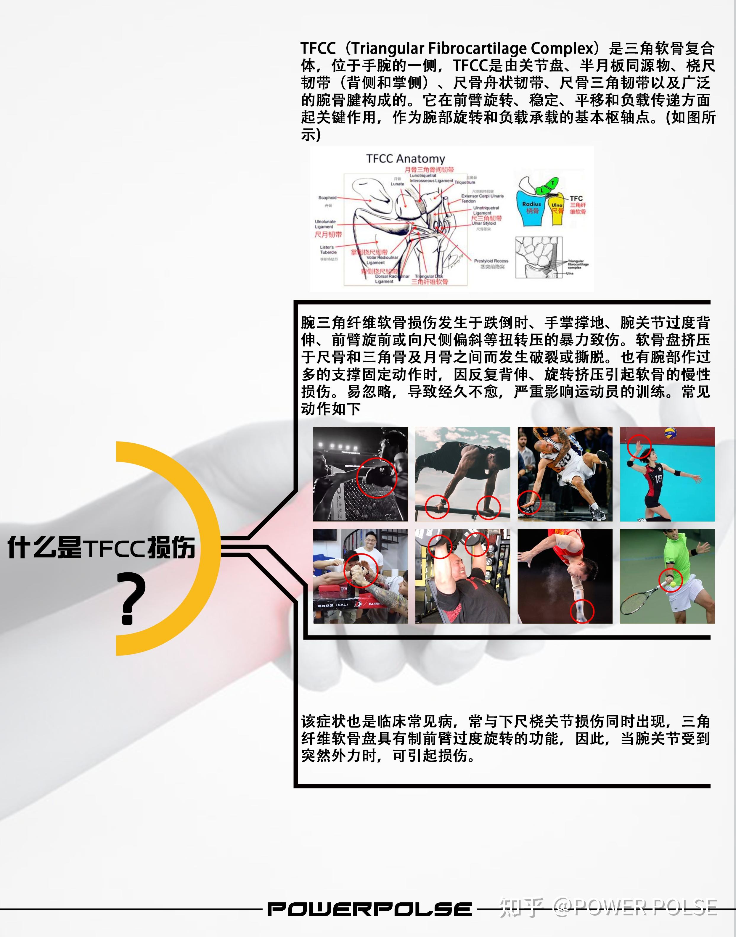 手腕TFCC损伤全攻略，跟着思维导图逐步康复！ - 知乎