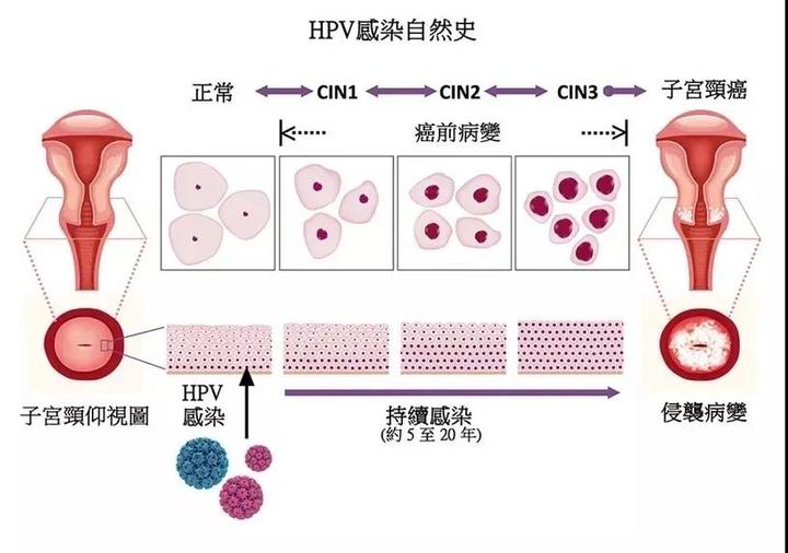 Hpv58阳性,宫颈上皮鳞状病变就医过程以及教训 知乎
