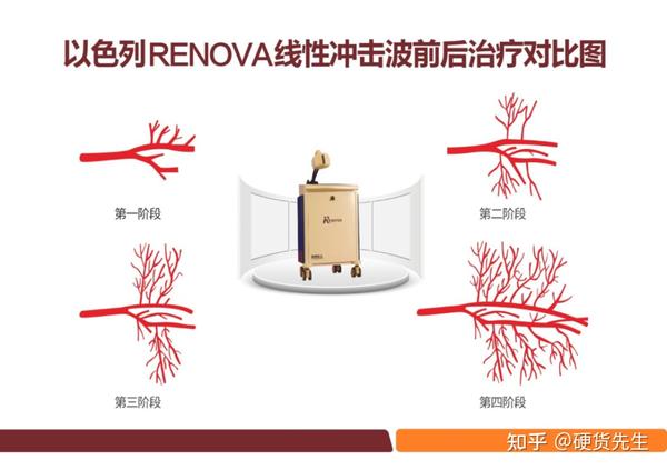 杭州阳痿早泄患者的福音：Renova低能量冲击波治疗找回性福 - 知乎