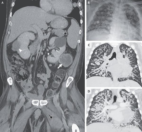 Nejm 2023 Case 20 - 知乎