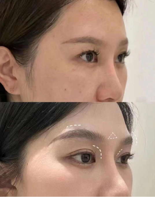 眉弓对颜值的影响有多大?什么人适合做眉弓?一般选什么材料合适? 知乎