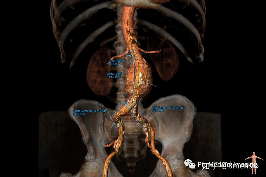 3mensio vascular - 知乎