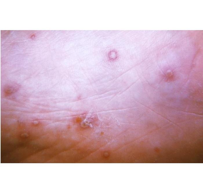 Web-scraped Skin Image 皮肤病诊断数据集介绍 - 知乎