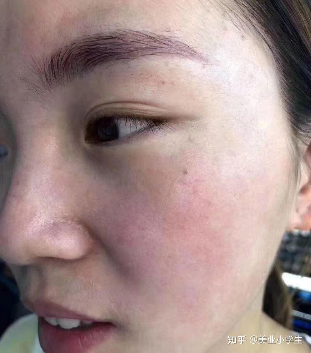 【皮秒能和其他项目一起做吗?一般需要间隔多久?】 知乎