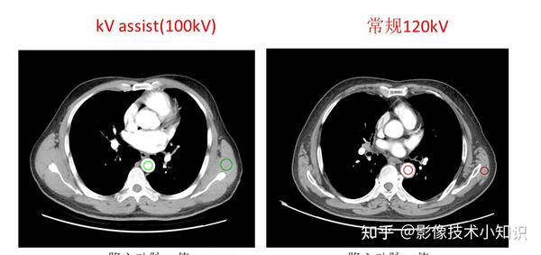常见的CT降低辐射剂量的技术 - 知乎