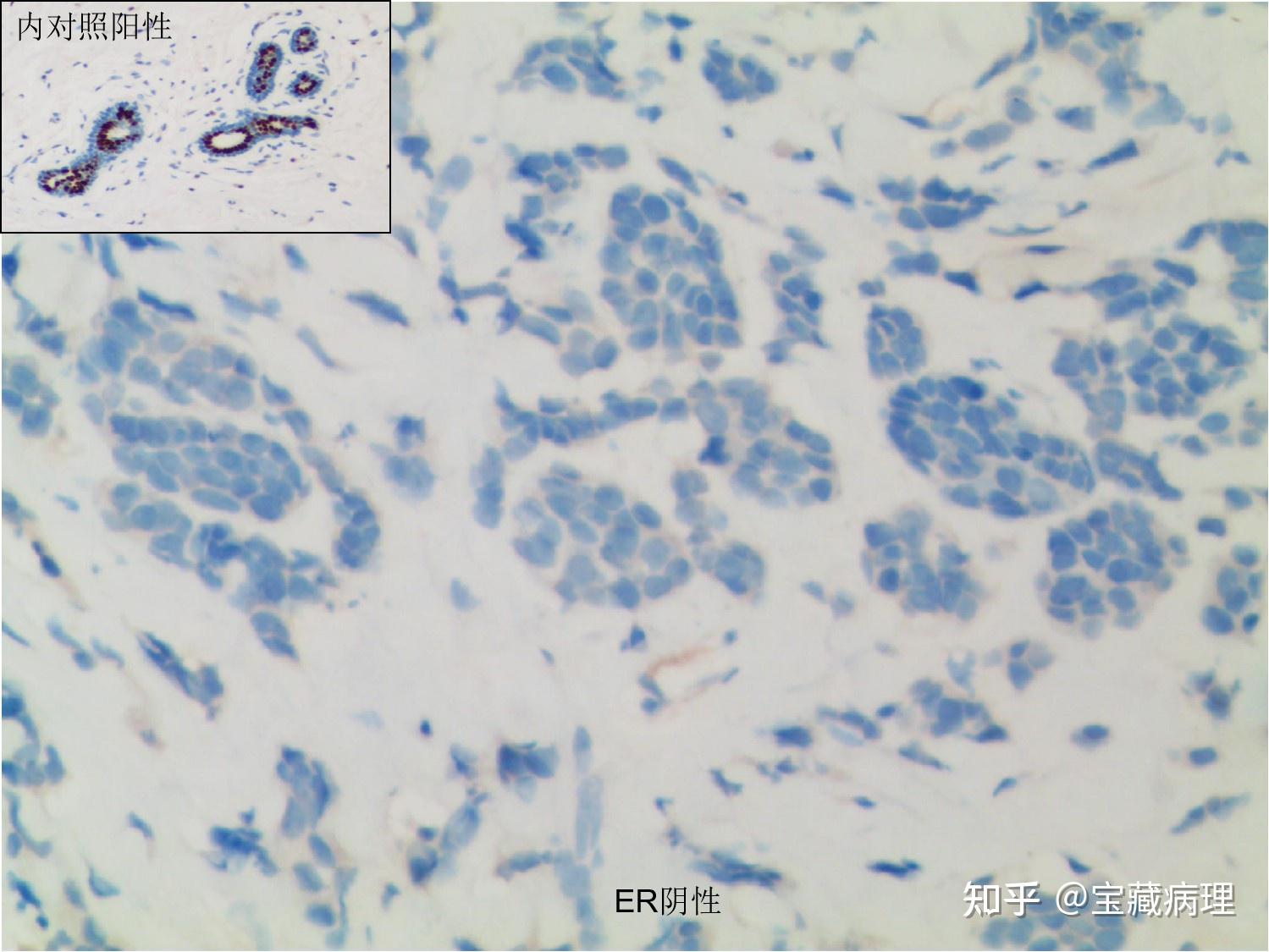 病理规培：一文掌握乳腺癌ER、PR免疫组化判读 - 知乎