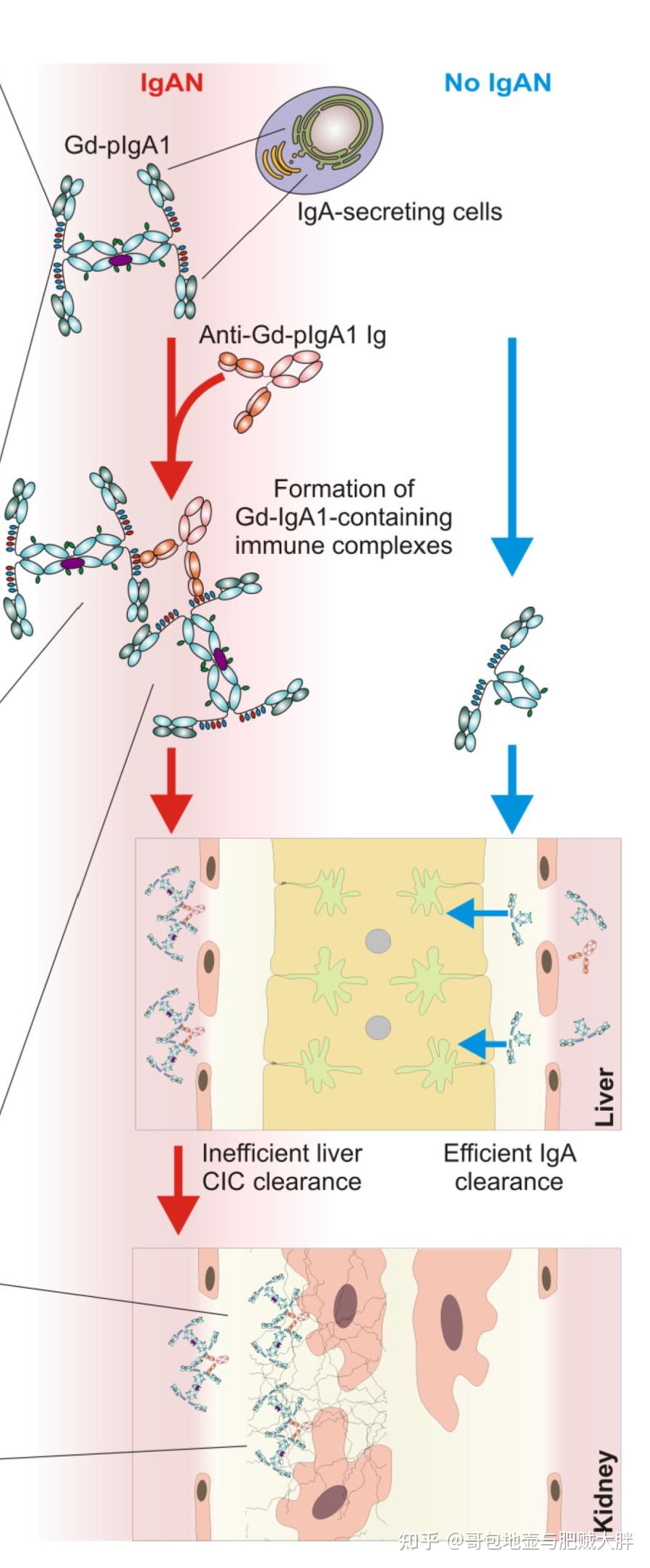 我的IgA肾病是咋得的？（下） - 知乎