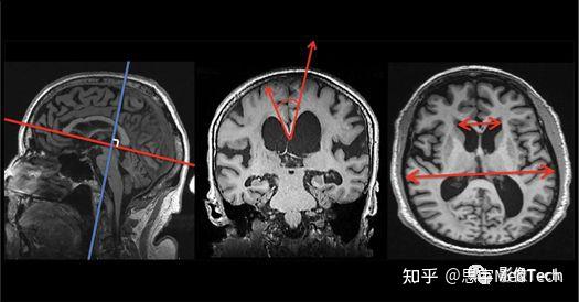 Pixyl：头部MRI分析AI软件获批FDA！ - 知乎