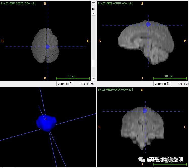 BraTS2023-MEN——BraTS2023颅内脑膜瘤分割挑战赛 - 知乎
