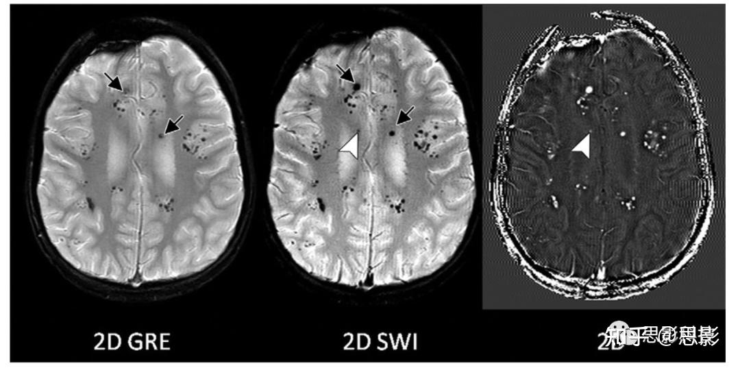 磁敏感加权成像（SWI)：技术要点和临床神经学应用 - 知乎