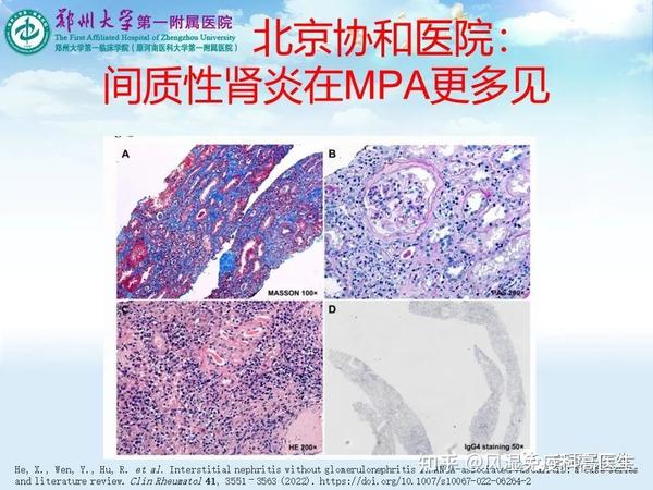 2022年ANCA相关血管炎诊疗进展 - 知乎