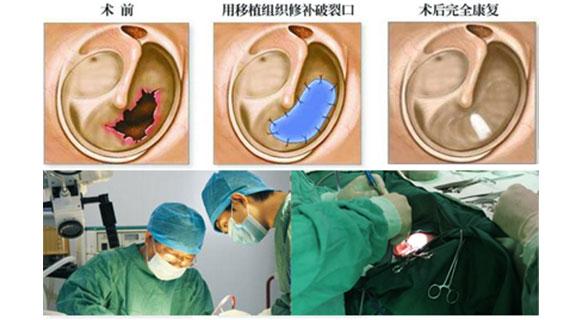 深圳友谊医院耳鼻喉科 深圳鼓膜穿孔医院 知乎